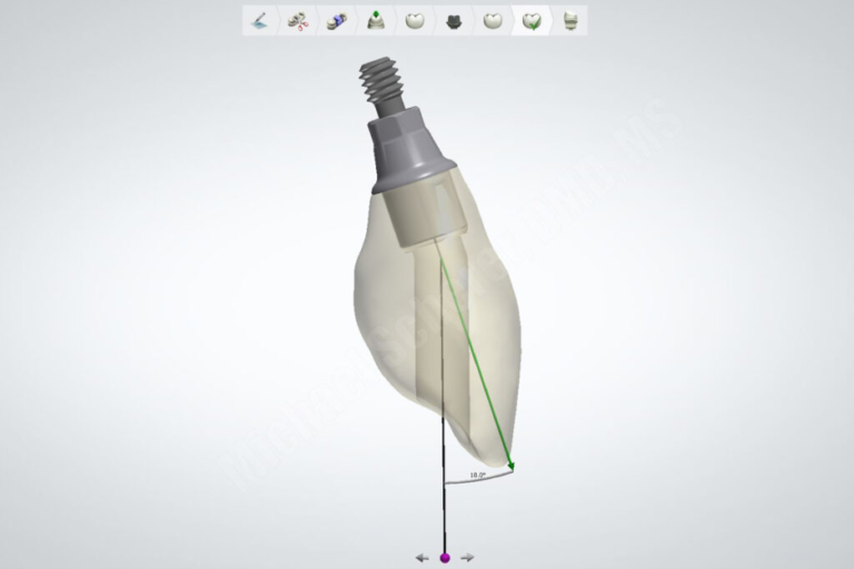 Implants - First Choice Dental Lab