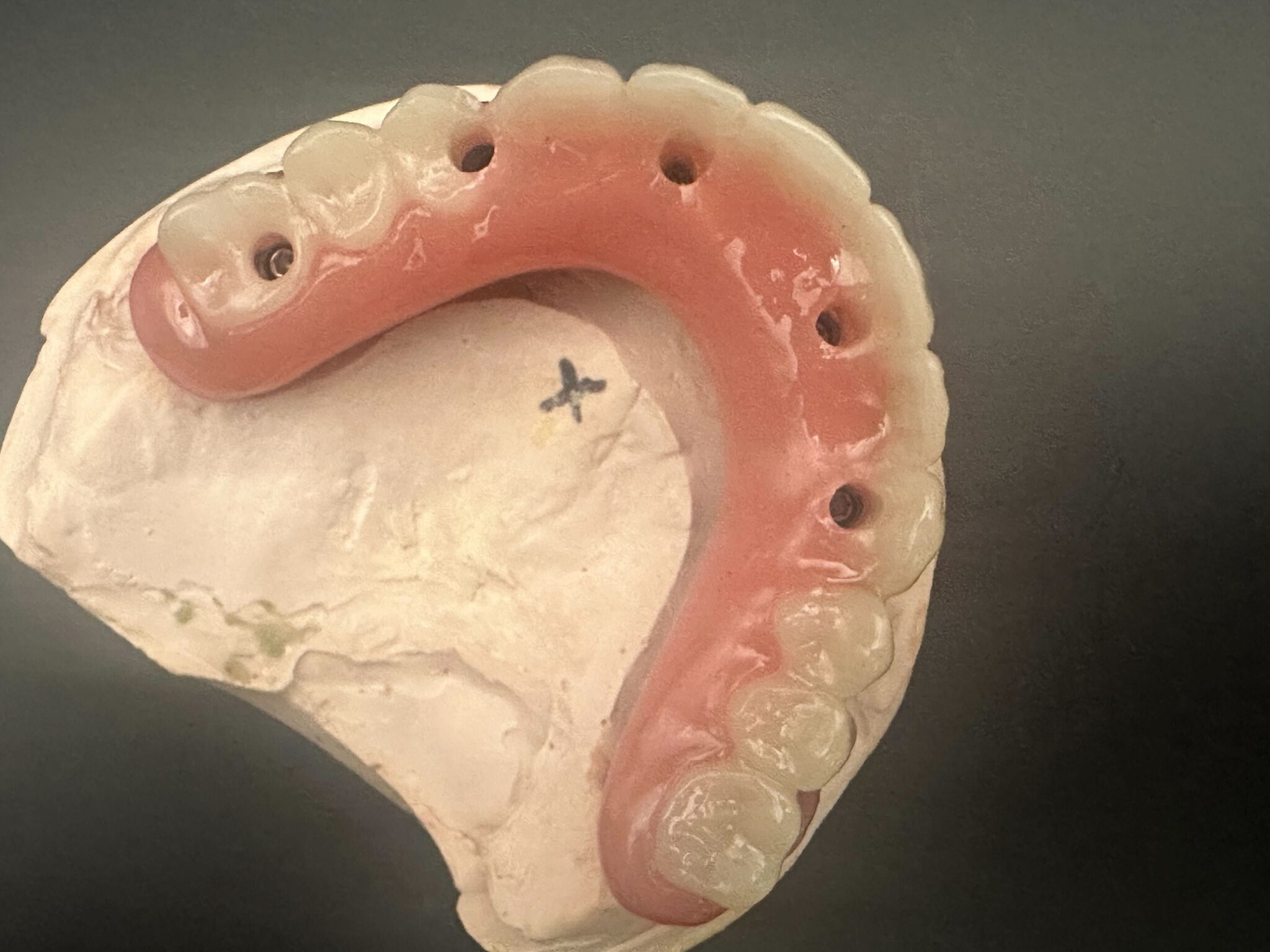 All-on-X Planning: The Keys to Success - First Choice Dental Lab